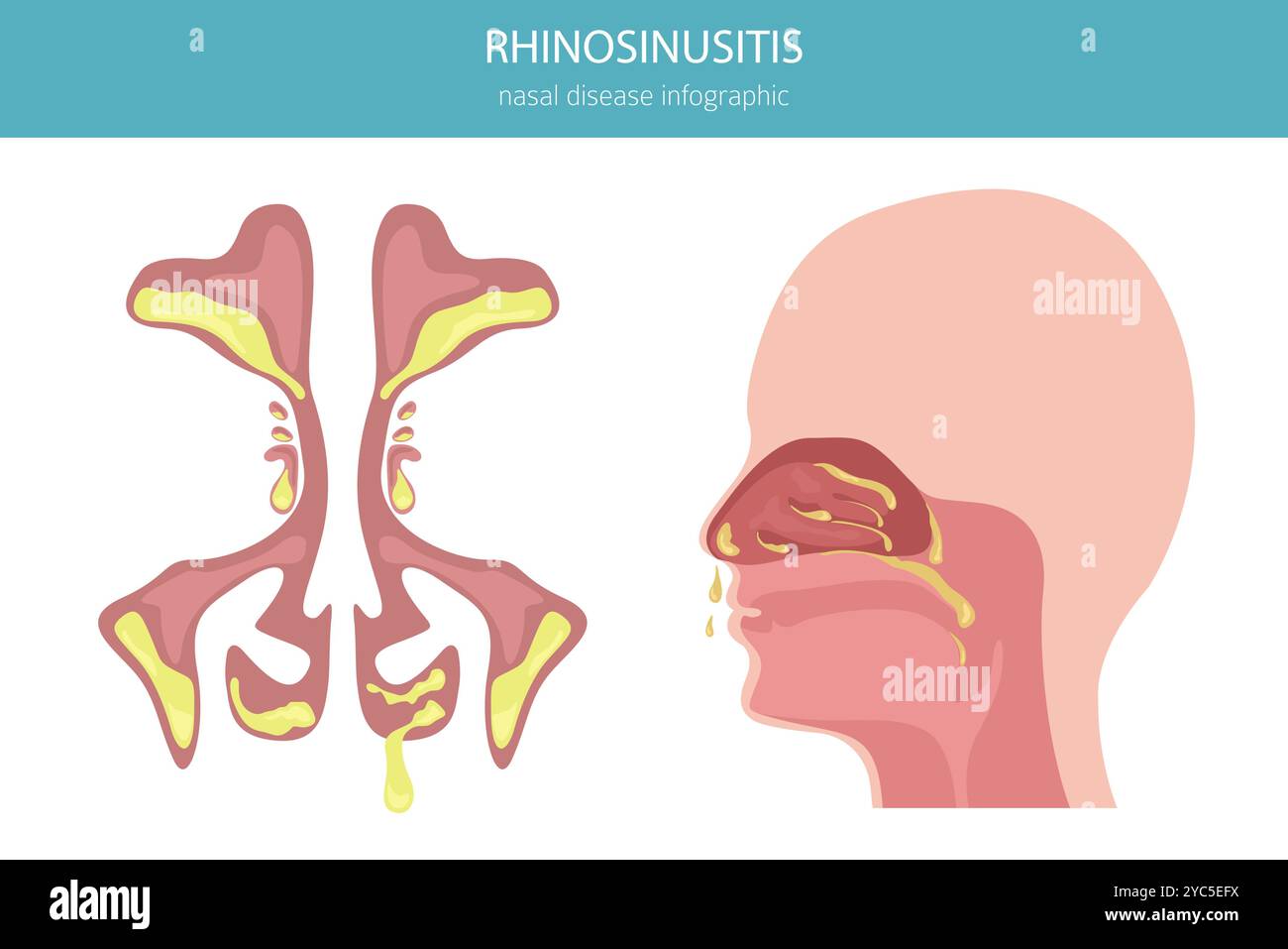 Rhinosinusitis. Nasal diseases. Sinusitis, sinus infection diagnosis and treatment medical ...