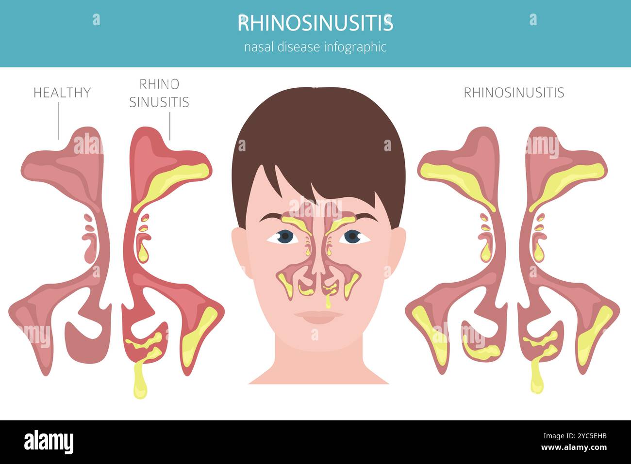 Rhinosinusitis. Nasal diseases. Sinusitis, sinus infection diagnosis and treatment medical ...