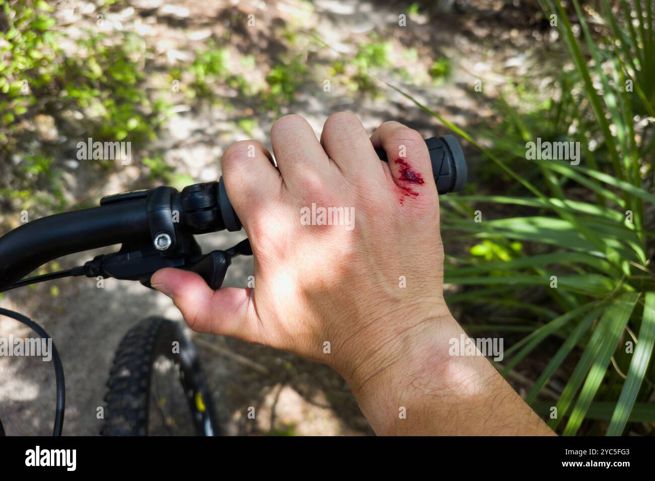 Bike rider hand injury with red blood from hitting a tree stump ...