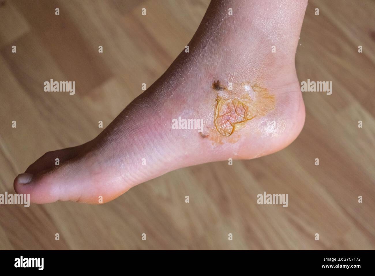 A close-up view of a persons foot showing healed skin from a burst ...