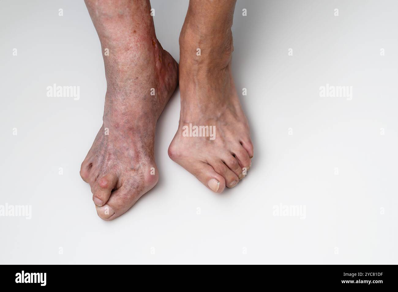 Overhead shot captures feet of senior woman, showing visible effects of ...