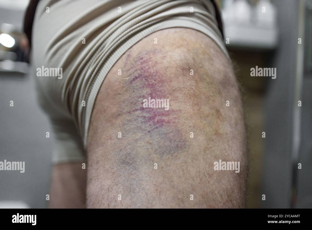 Thigh Injury from a collision, impact or fall, bruised man leg. Injury.Huge yellow-blue bruise ...