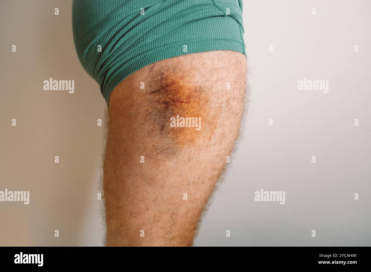 Thigh Injury from a collision, impact or fall, bruised man leg. Injury ...
