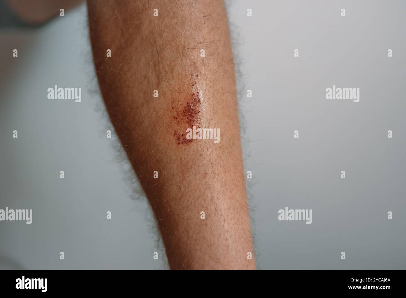 Scratch marks on skin surface cause by sharp fingernails scratching an ...