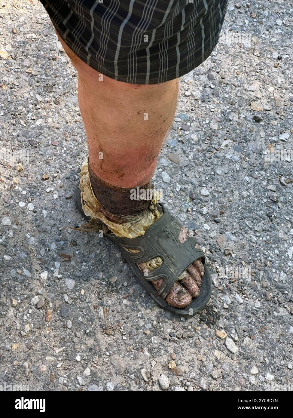 The signs of gangrene on a male foot wearing slippers and dirty bandage ...