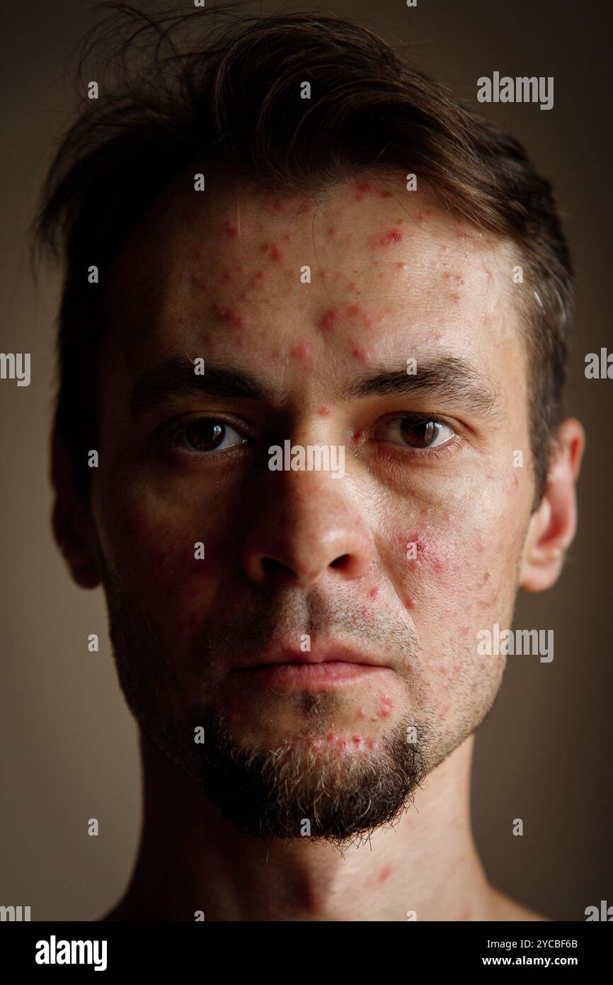 Red rash on the face of an adult male infected with chickenpox Stock ...