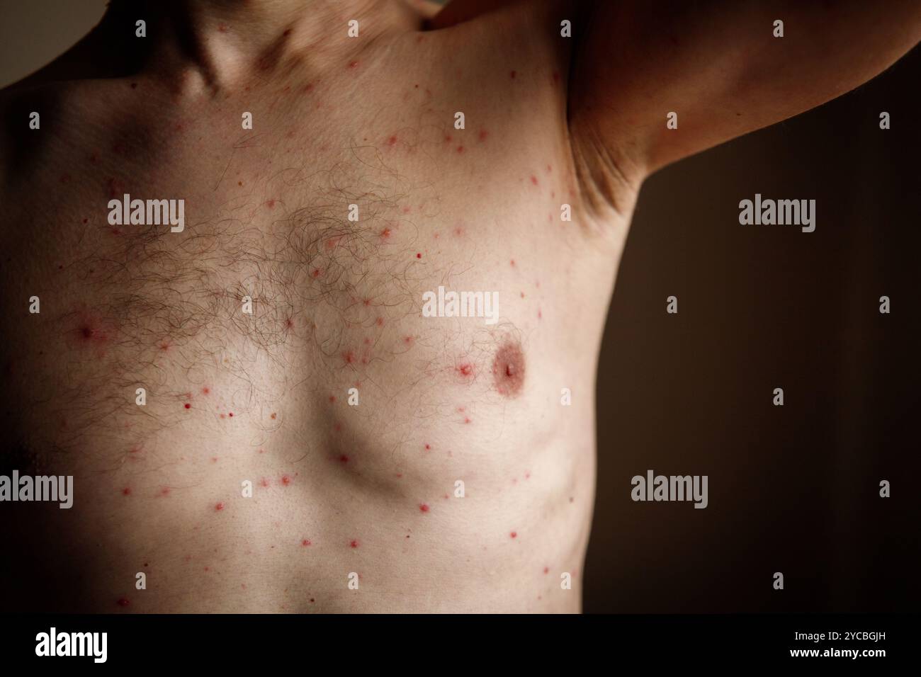 Red rash man's chest with varicella blisters, also known as chickenpox ...