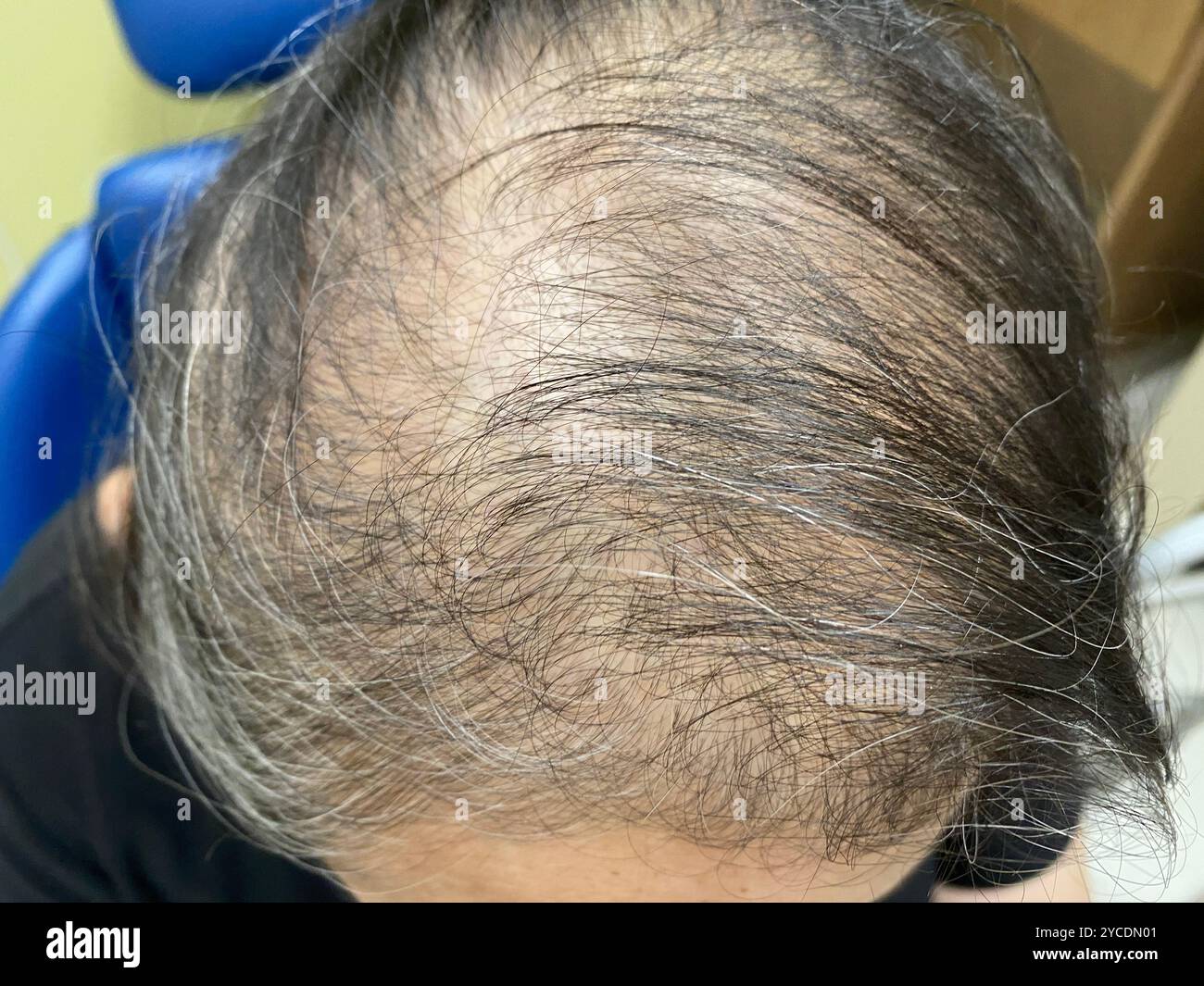 Scalp of a Hispanic patient with female pattern hair loss, also known ...