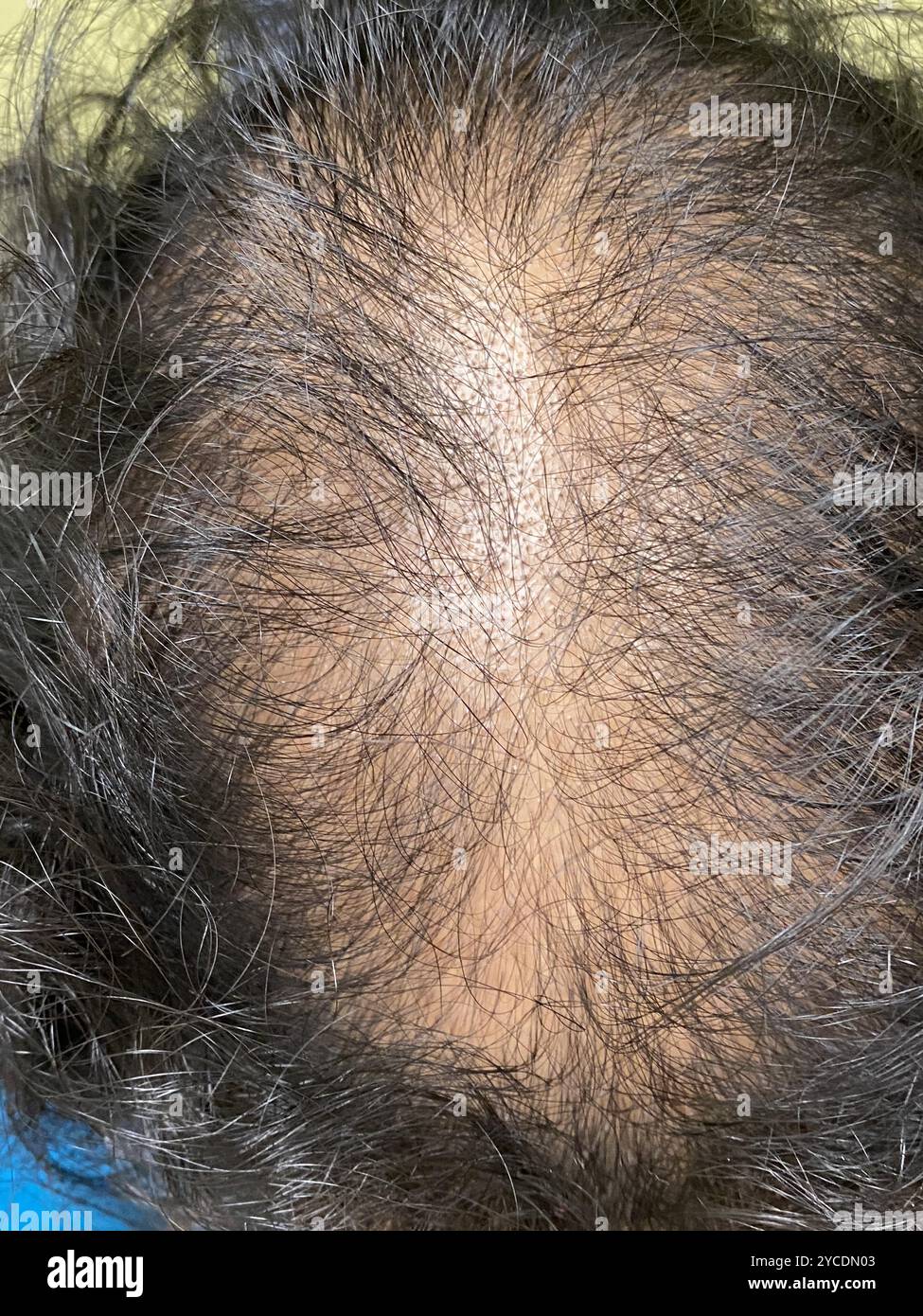 Scalp of a Hispanic patient with female pattern hair loss, also known ...