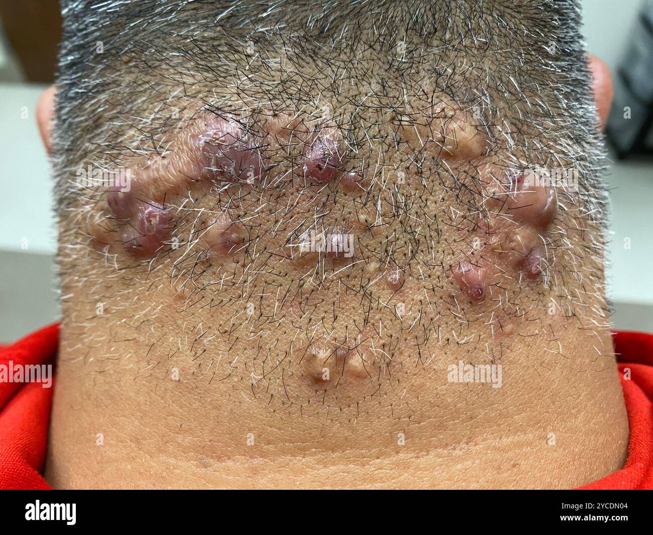 Acne keloidalis nuchae (AKN) on the back of a Hispanic male patient's ...