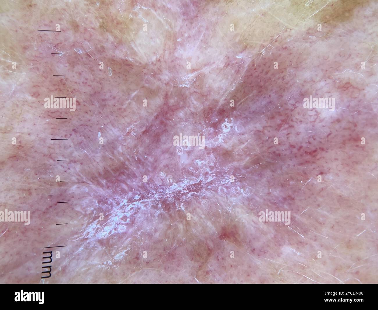 Dermatoscope image of an actinic keratosis on a white female patient's ...