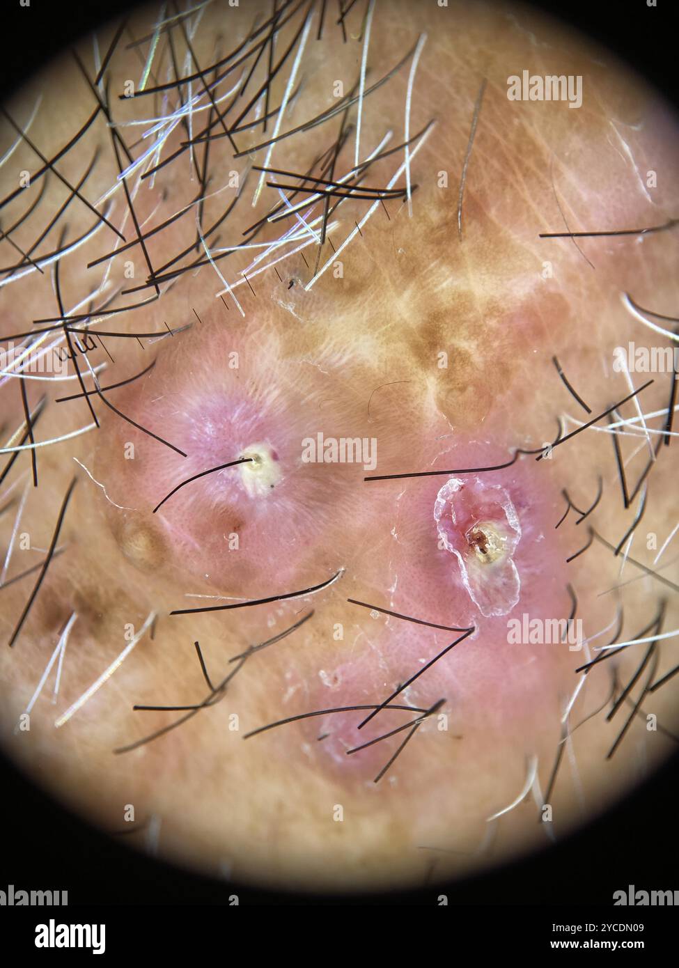 Dermatoscope image of acne keloidalis nuchae (AKN) on a Hispanic male ...
