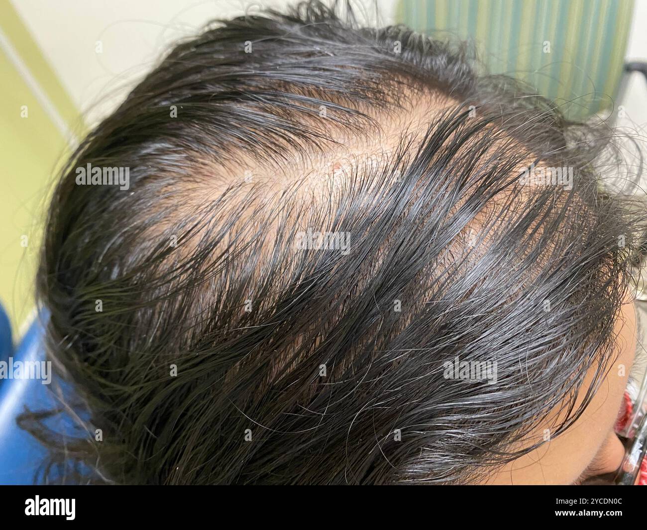 Scalp of a patient with female pattern hair loss, also known as female ...