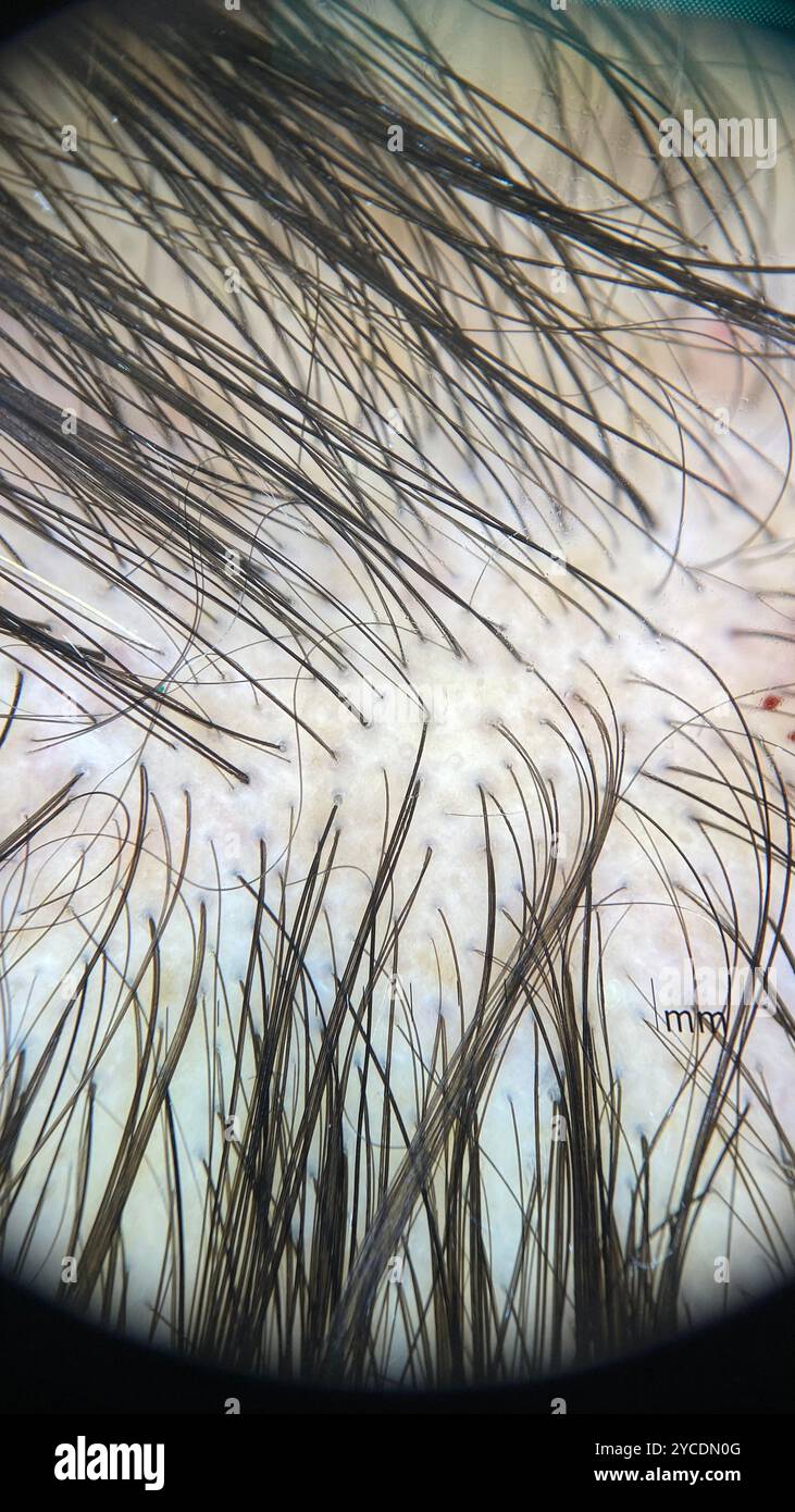 Dermatoscope image of the scalp of a patient with female pattern hair ...