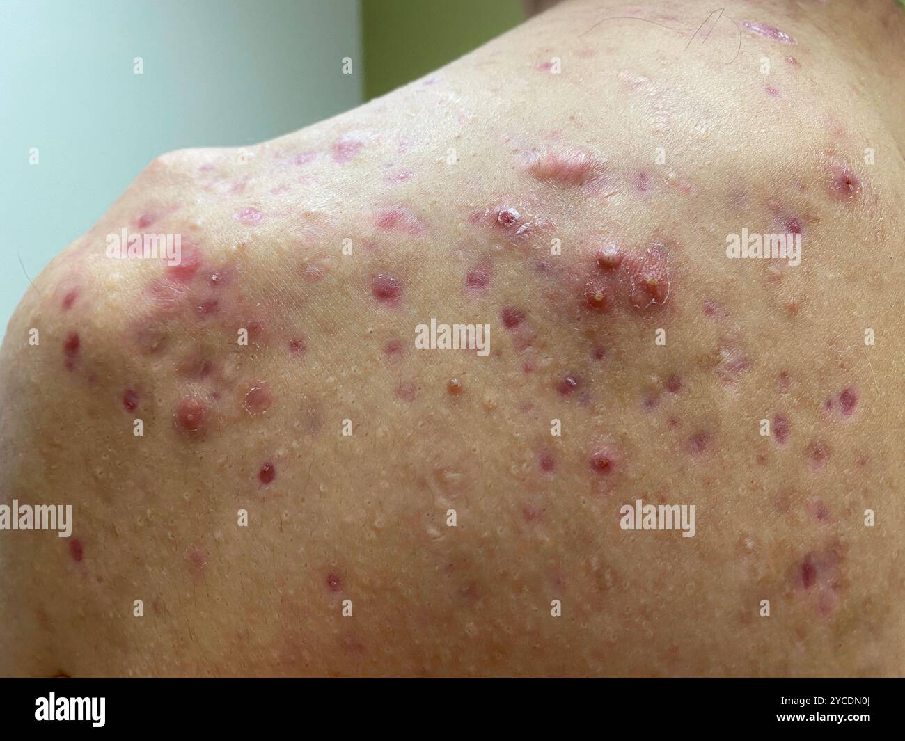 Severe acne on the back of a 17 year old male patient. Acne is a ...