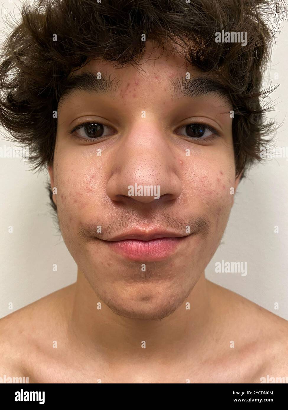 Acne on the face of a 17 year old male patient. Acne is a general name ...