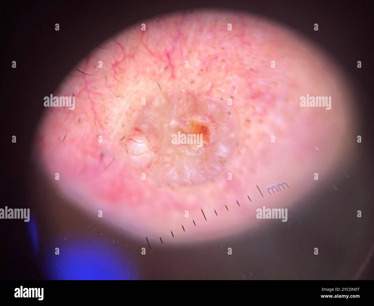 Dermatoscope image of a basal cell carcinoma (BCC), or rodent ulcer, on ...