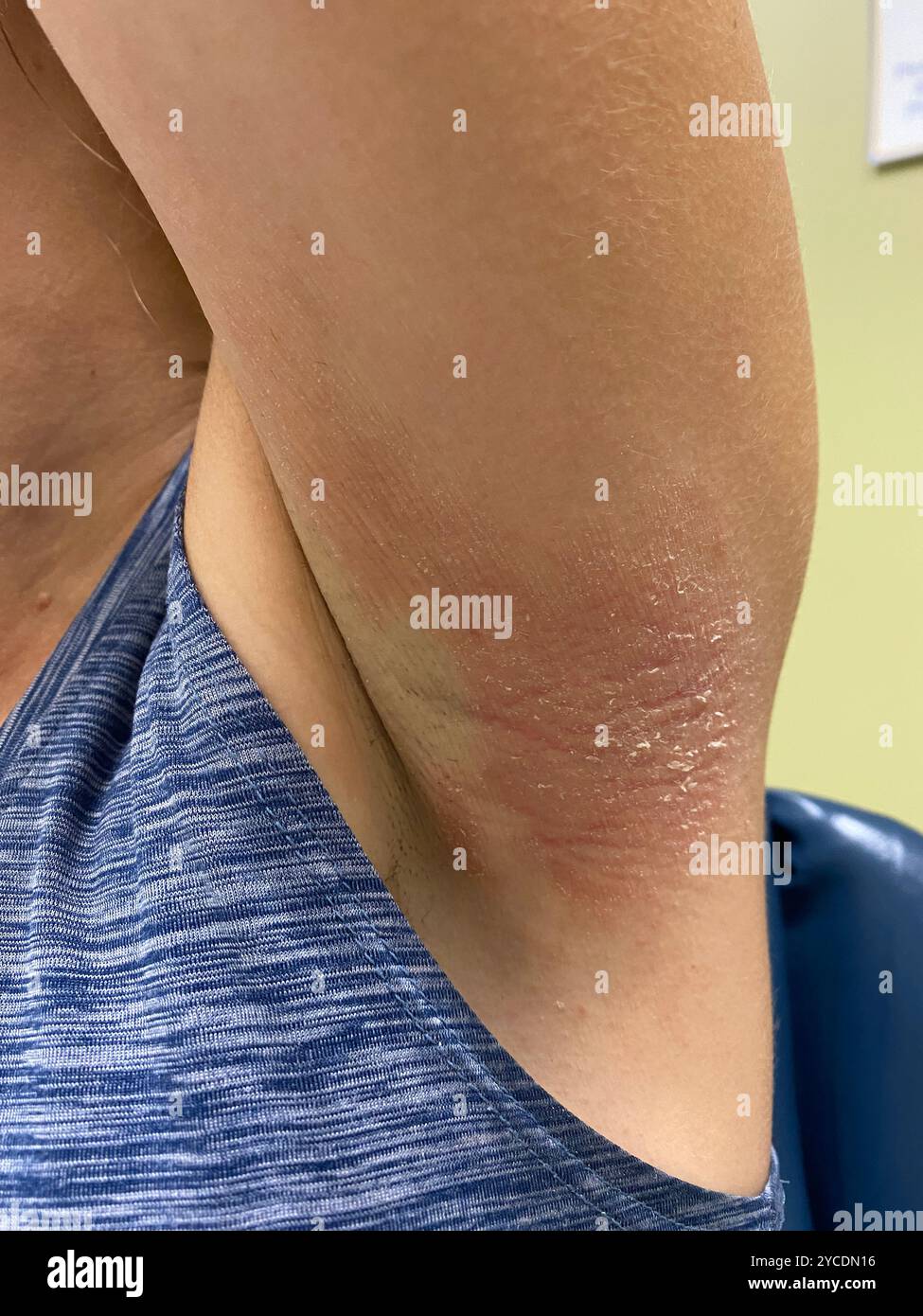 Contact dermatitis in the armpit of a 28 year old white female patient ...