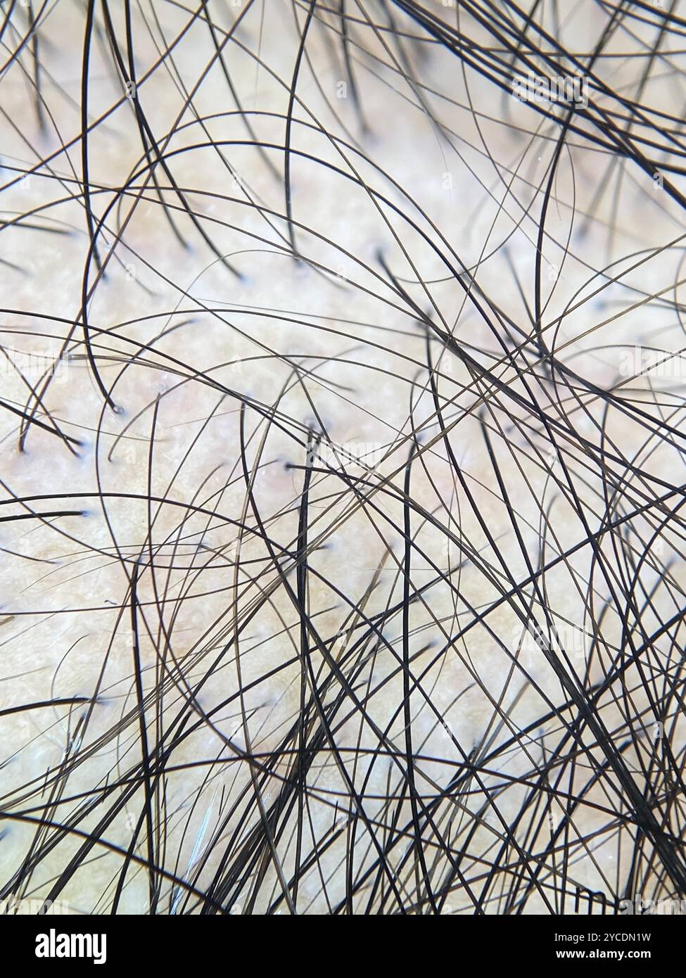 Dermatoscope image of the scalp of a Hispanic patient with female ...