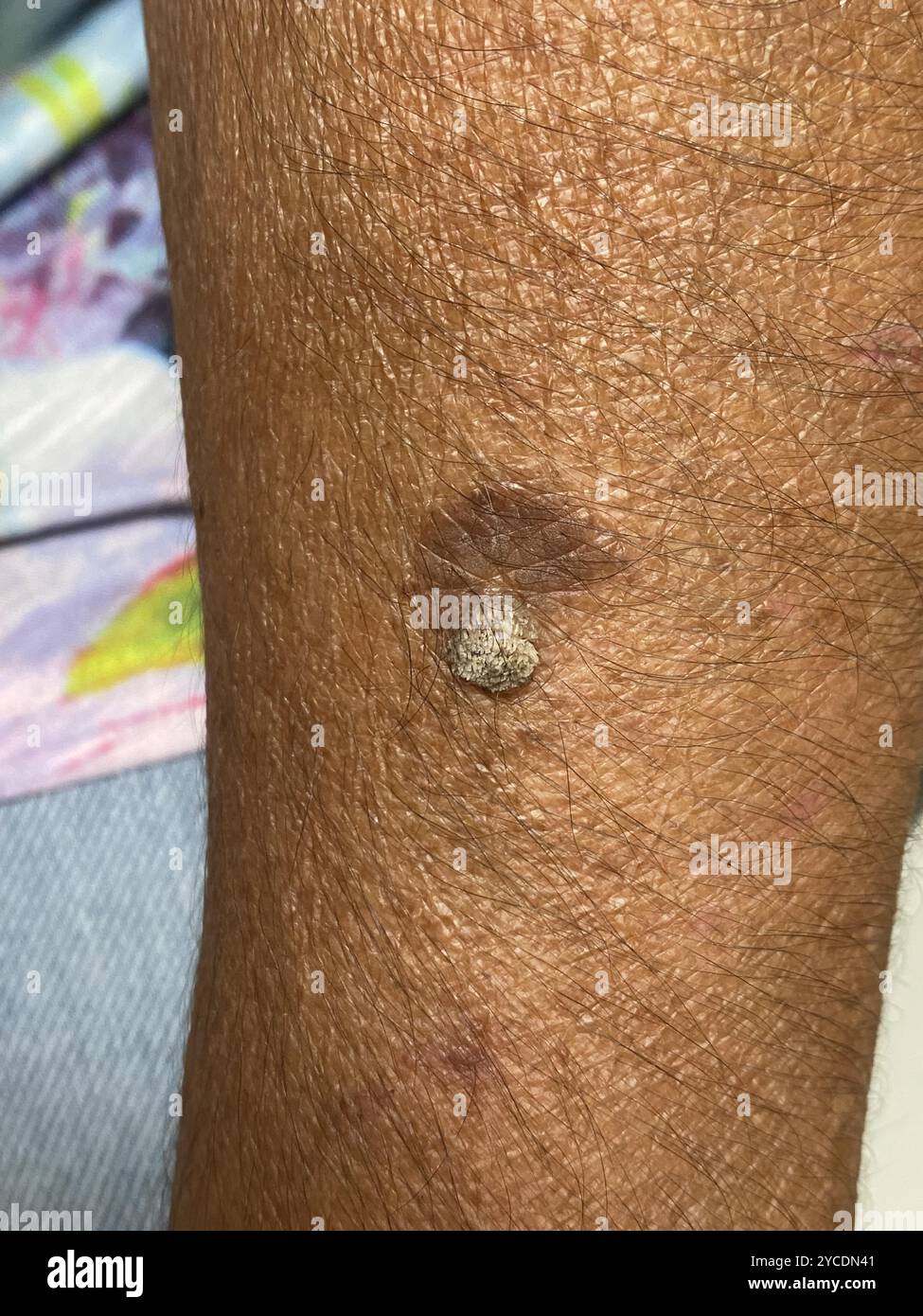 Filiform wart on a patient's arm. Warts are caused by infection with a ...
