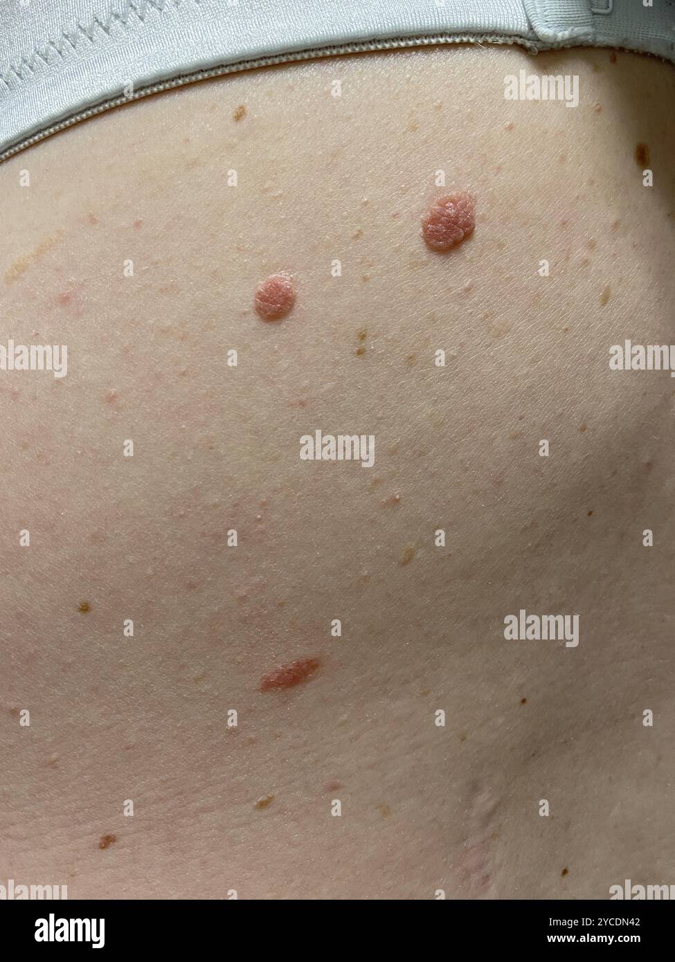 Intradermal naevi on a patient's back. These are benign skin growths ...