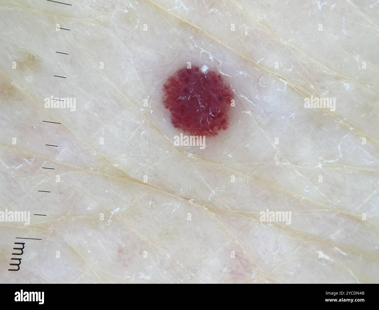 Dermatoscope image of a haemangioma on a patient's skin. Haemangiomas ...