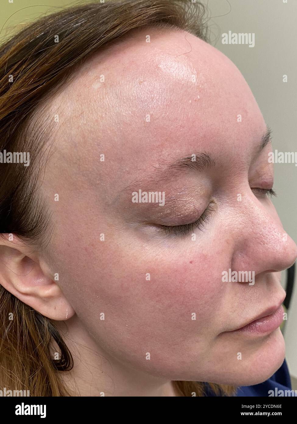 Frontal fibrosing alopecia affecting a 33 year old female patient. This ...
