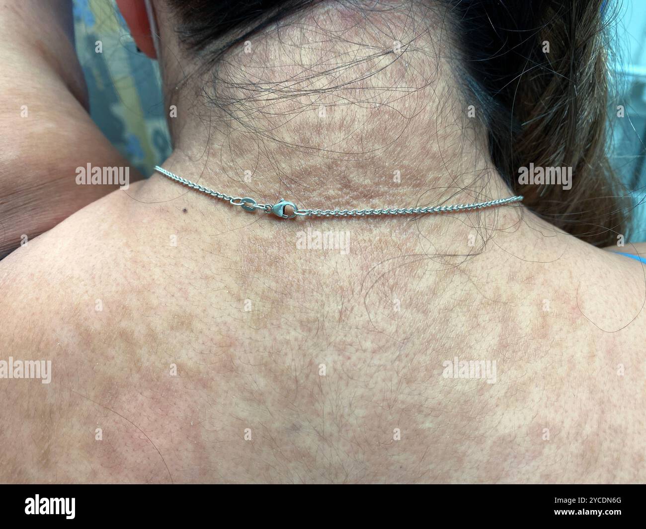 Confluent and reticulated papillomatosis on a 14 year old Hispanic ...