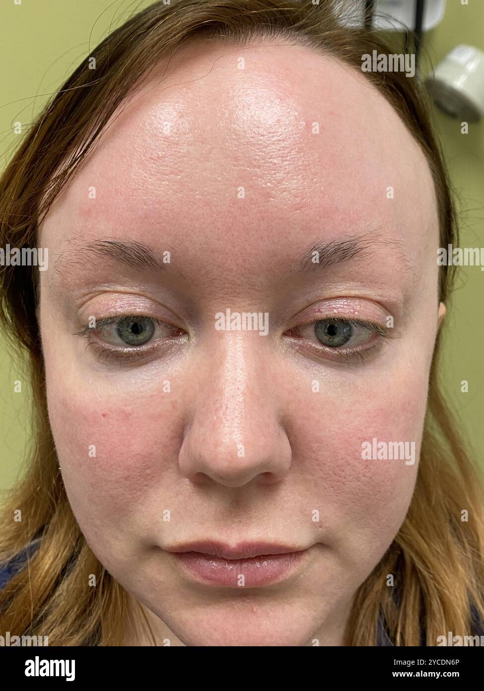 Frontal fibrosing alopecia affecting a 33 year old female patient. This ...