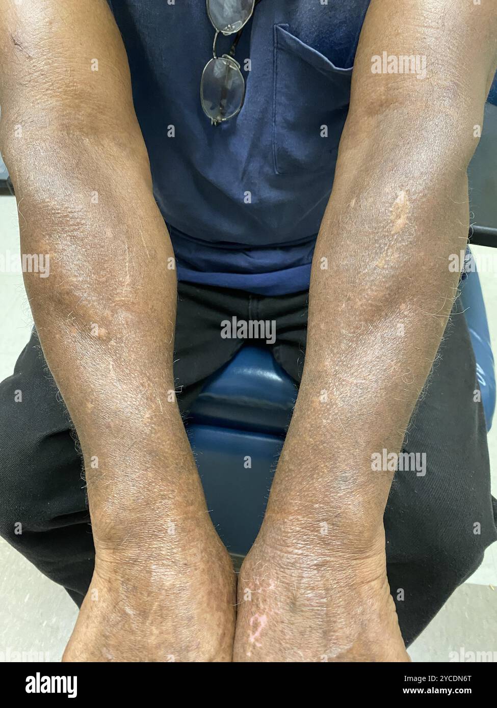 Arms of an Hispanic male patient with delusional infestation who is ...