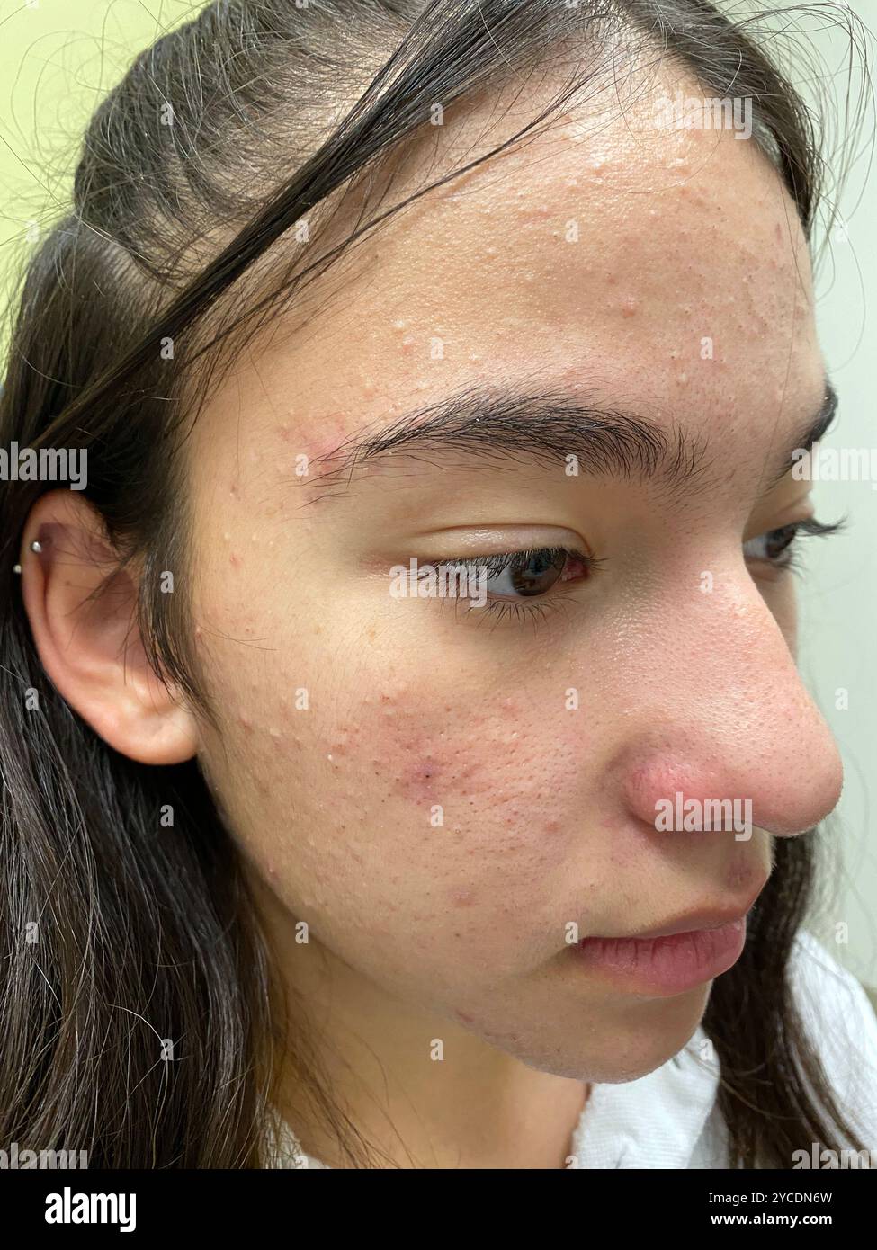 Acne on a teenage Hispanic female patient's face. Acne is a general ...