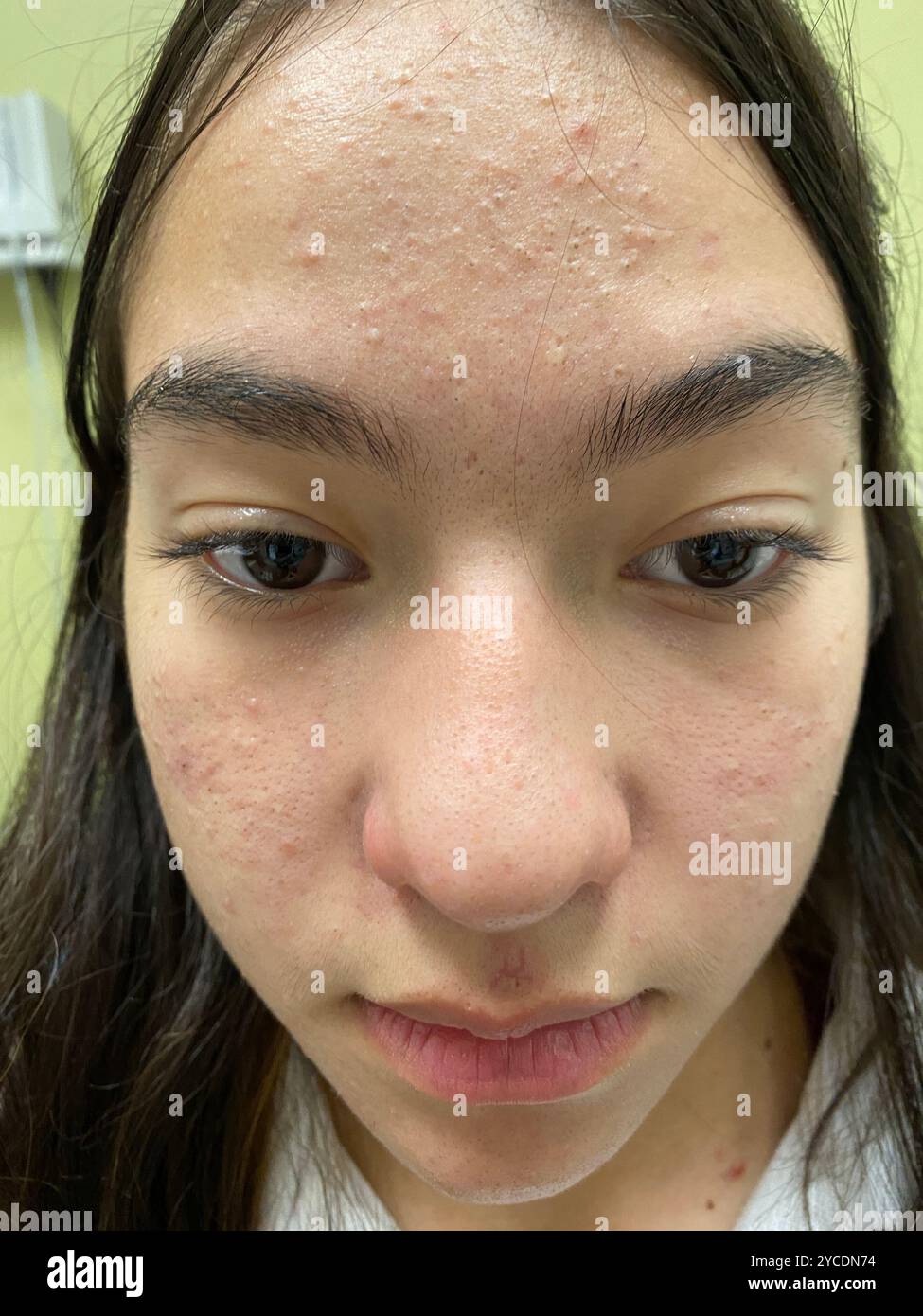 Acne on a teenage Hispanic female patient's face. Acne is a general ...