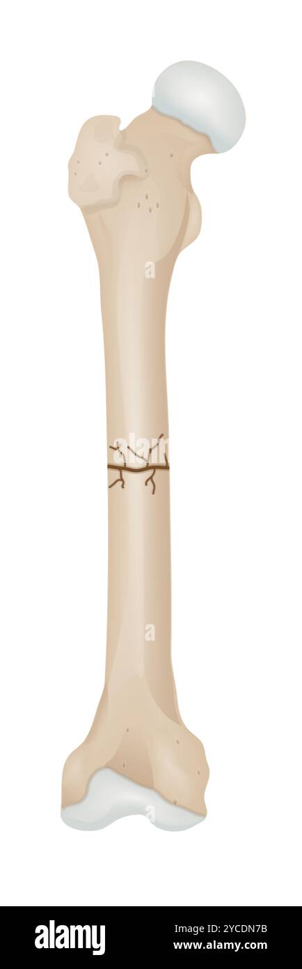 Illustration of a comminuted femur fracture. Comminuted fractures ...