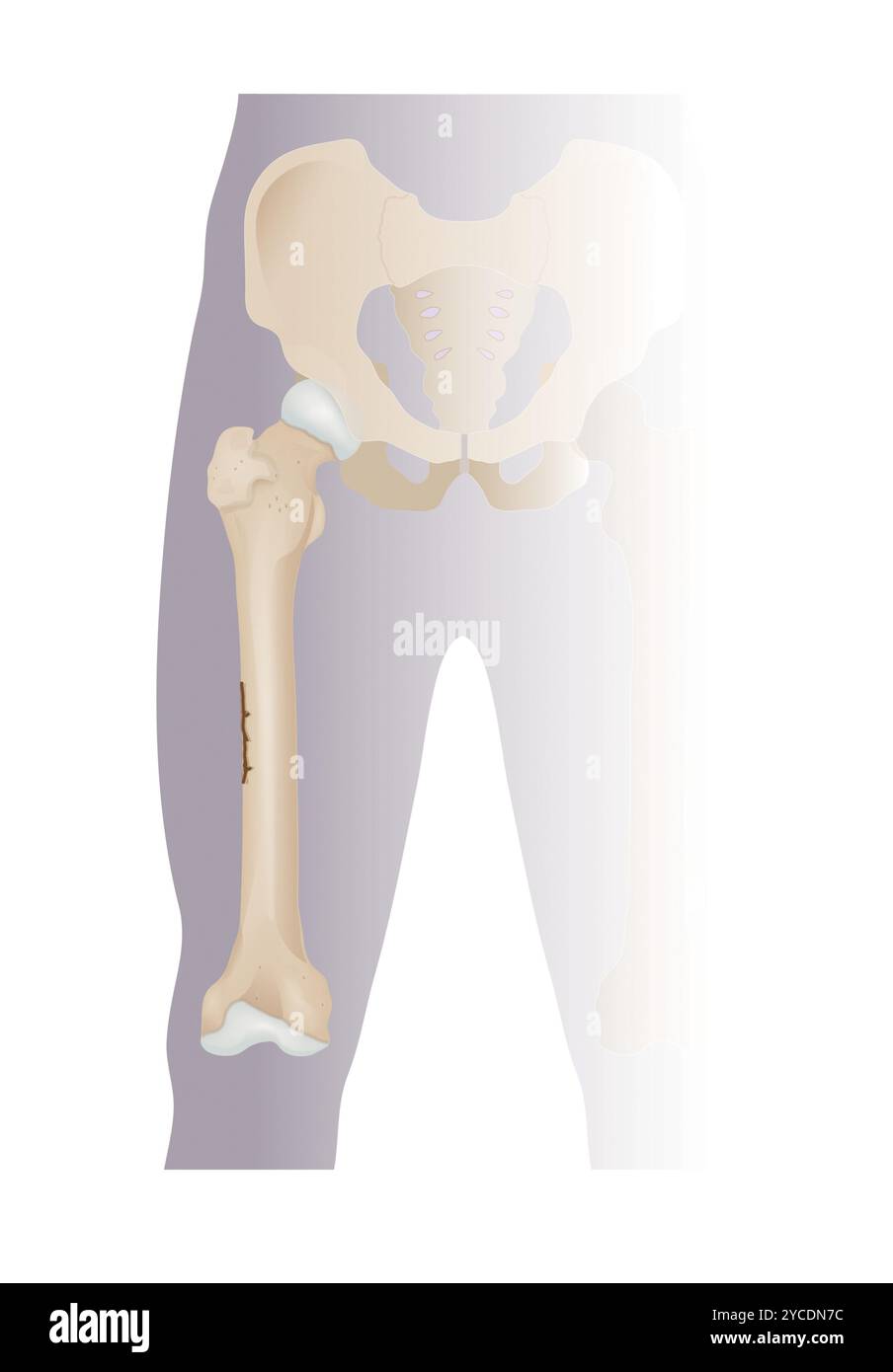 Illustration of a greenstick femoral fracture. Greenstick fractures happen when a fall or ...