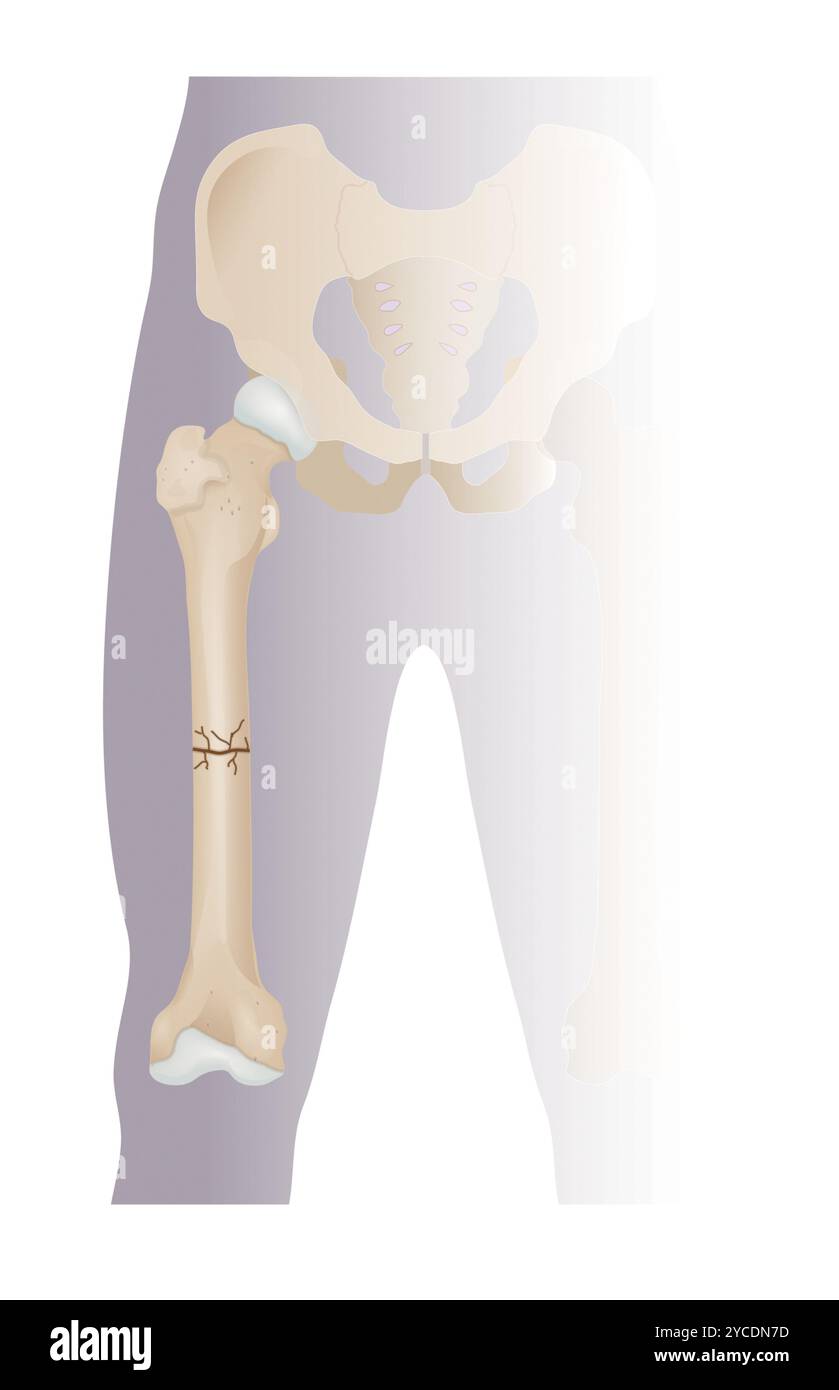 Illustration of a comminuted femur fracture. Comminuted fractures ...
