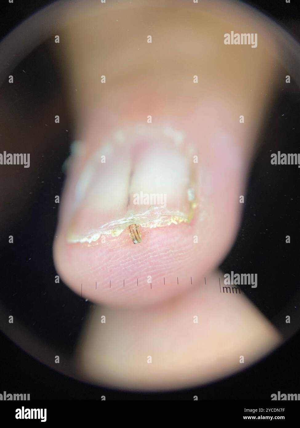 Dermatoscope image of an onychopapilloma, a benign (non-cancerous ...