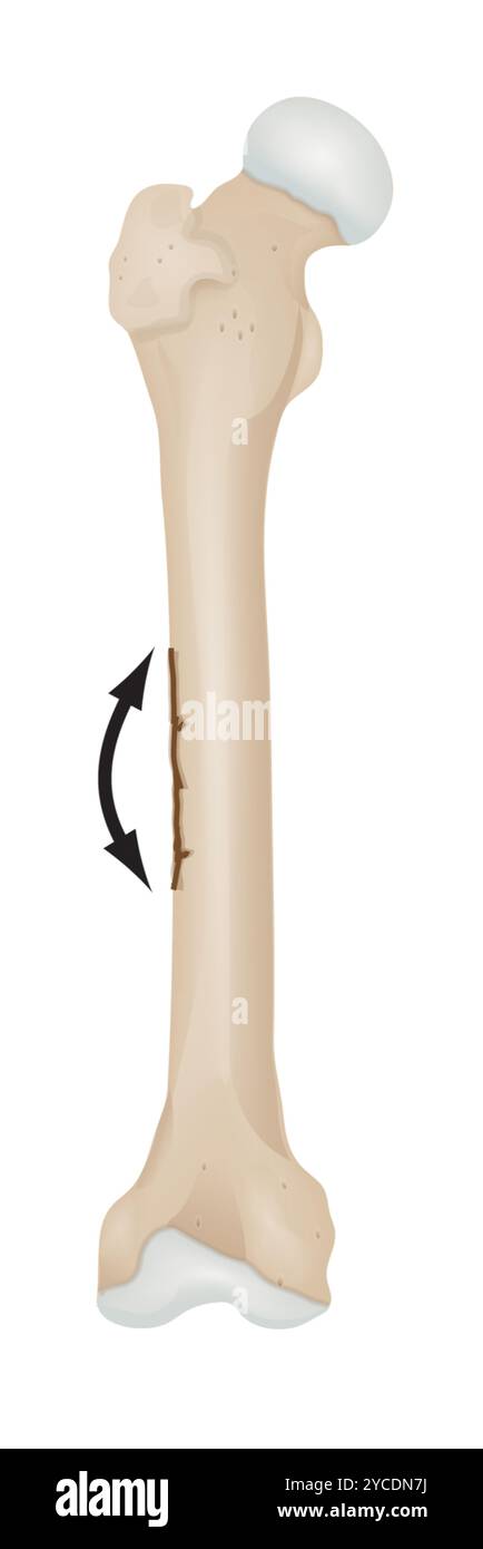 Illustration of a greenstick femur fracture. Greenstick fractures happen when a fall or accident ...