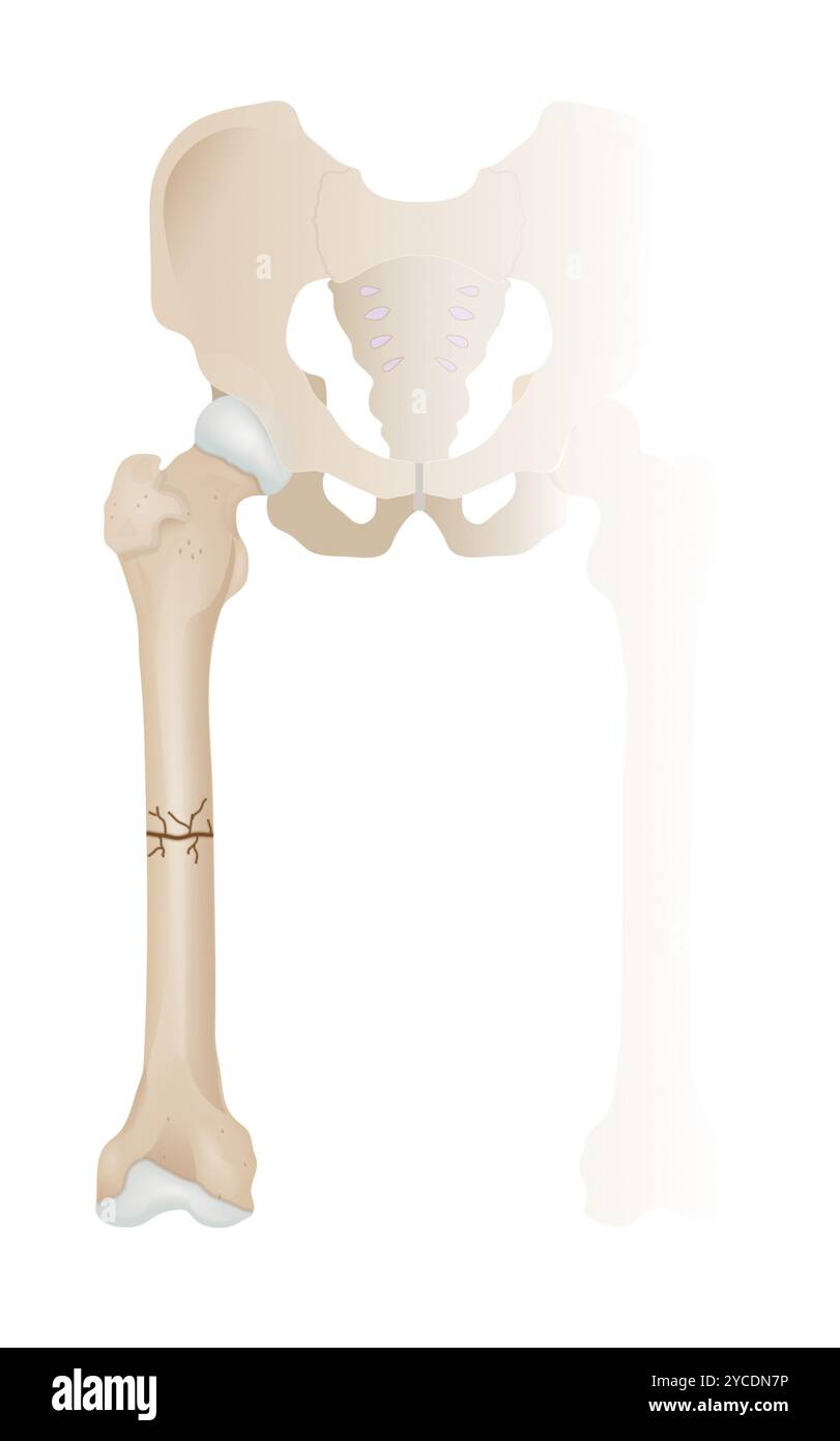 Illustration of a comminuted femur fracture. Comminuted fractures ...