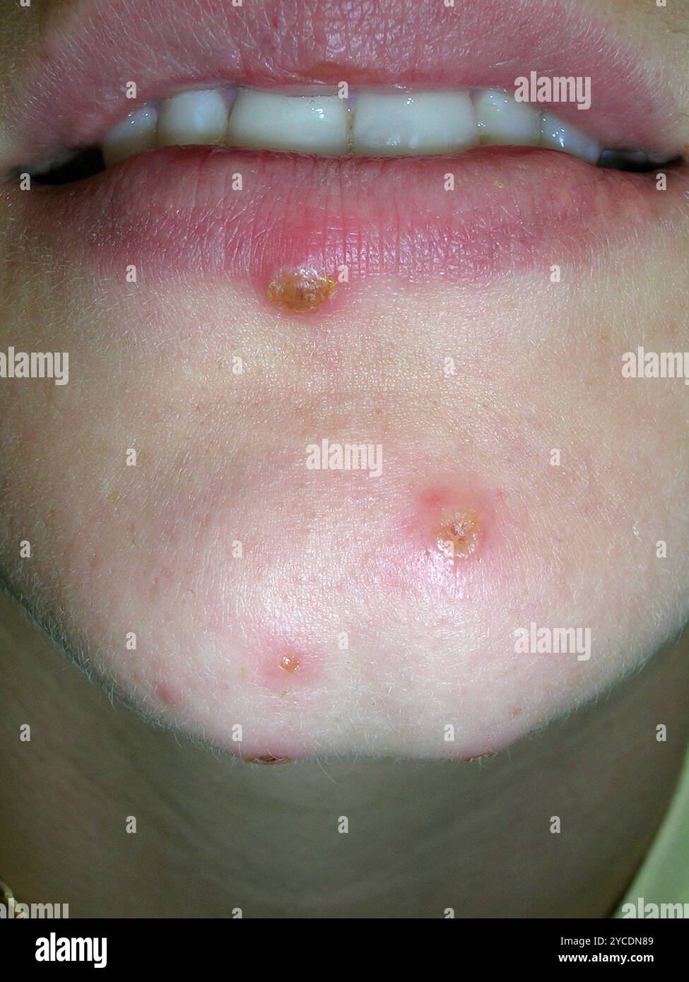 Impetigo and oral herpes. Impetigo is a bacterial skin infection caused ...