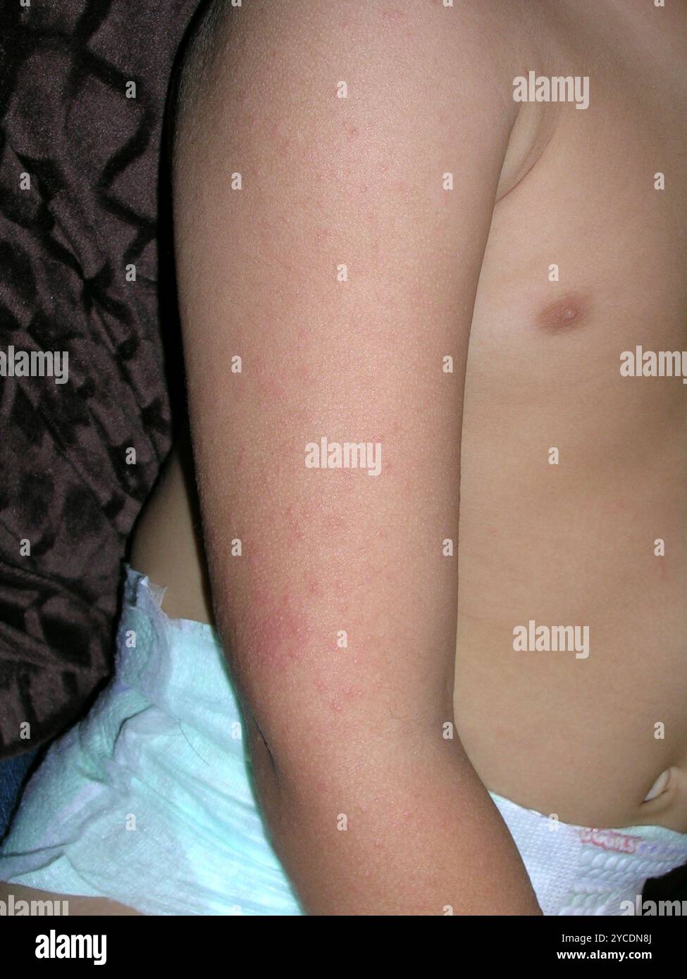 Gianotti-Crosti syndrome (infantile papular acrodermatitis) on the arm ...