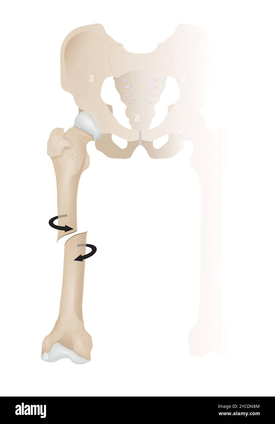 Illustration of a spiral femoral fracture. A twisting force to the ...