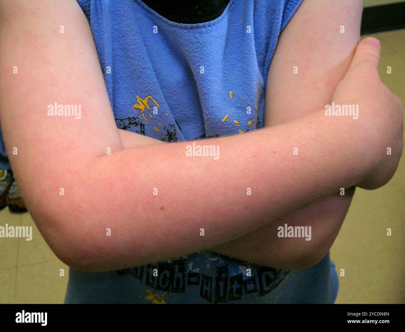 Reticular rash on the arms of a patient with fifth disease. Fifth ...