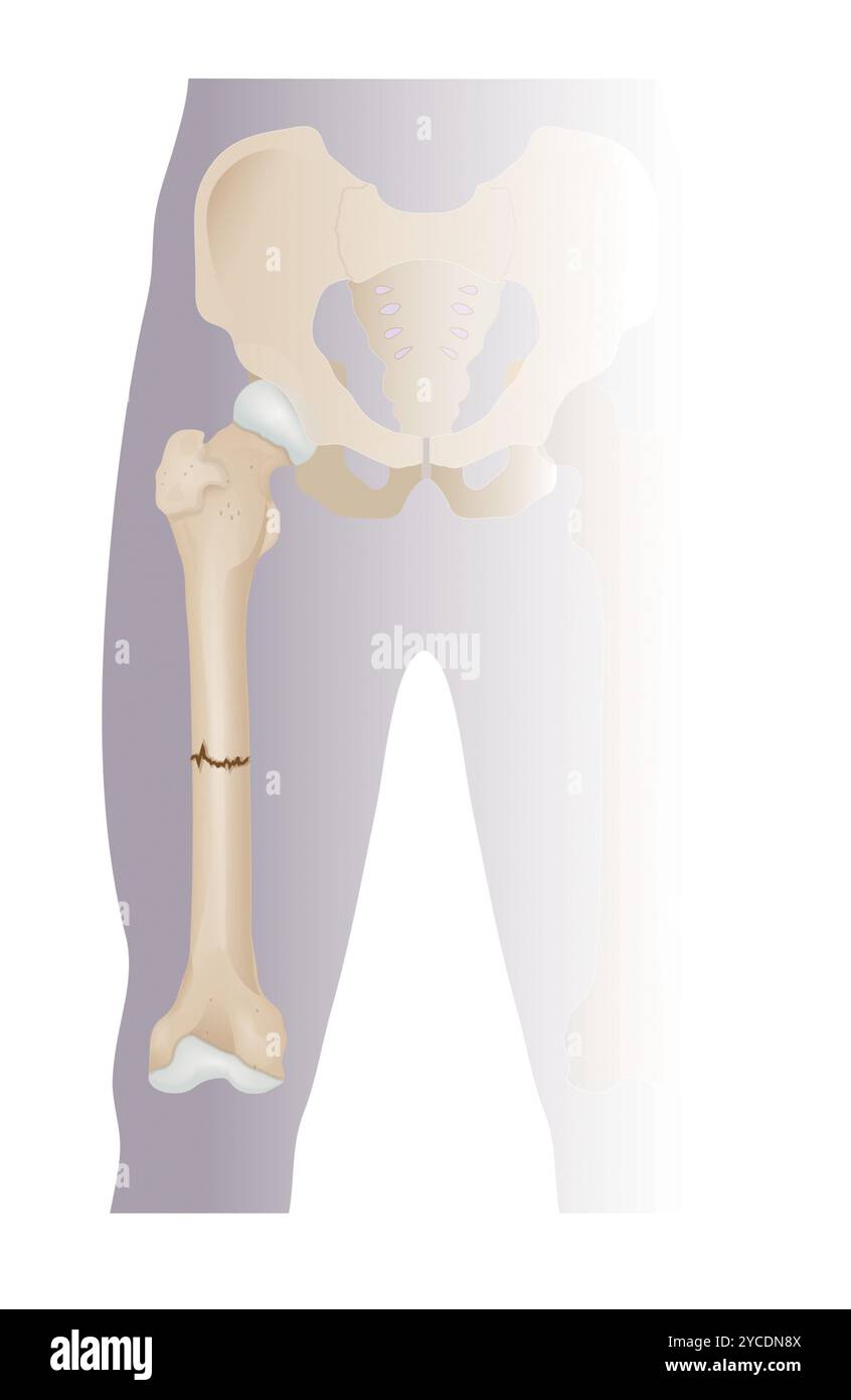 Illustration of a transverse femoral fracture. A transverse fracture is ...