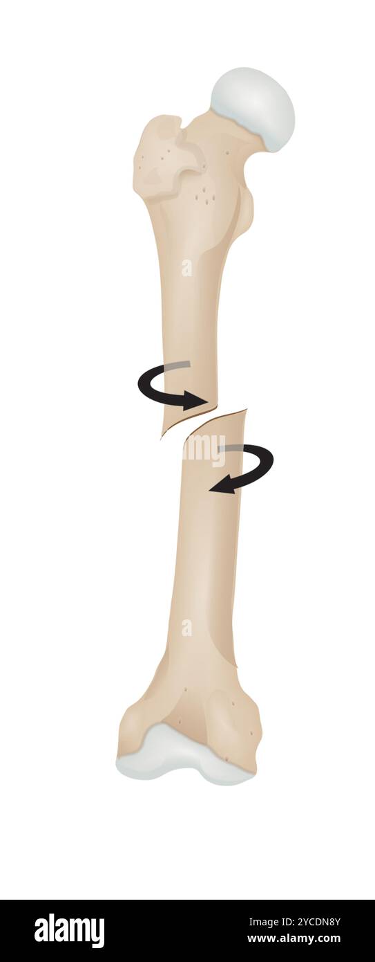 Illustration of a spiral femoral fracture. A twisting force to the ...