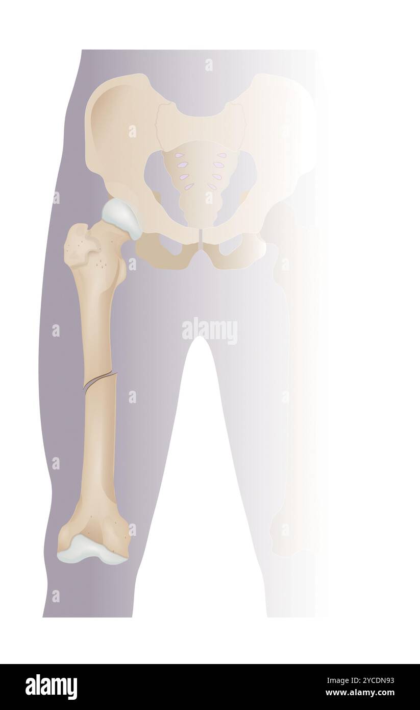 Illustration Of An Oblique Displaced Femur Fracture This Type Of