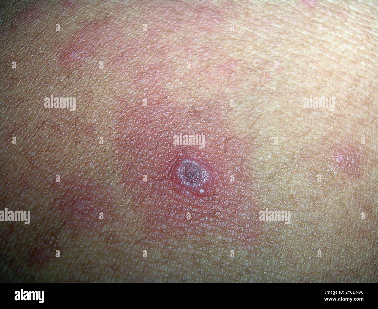 Chickenpox rash on a 27 year old male patient's skin. Chickenpox ...