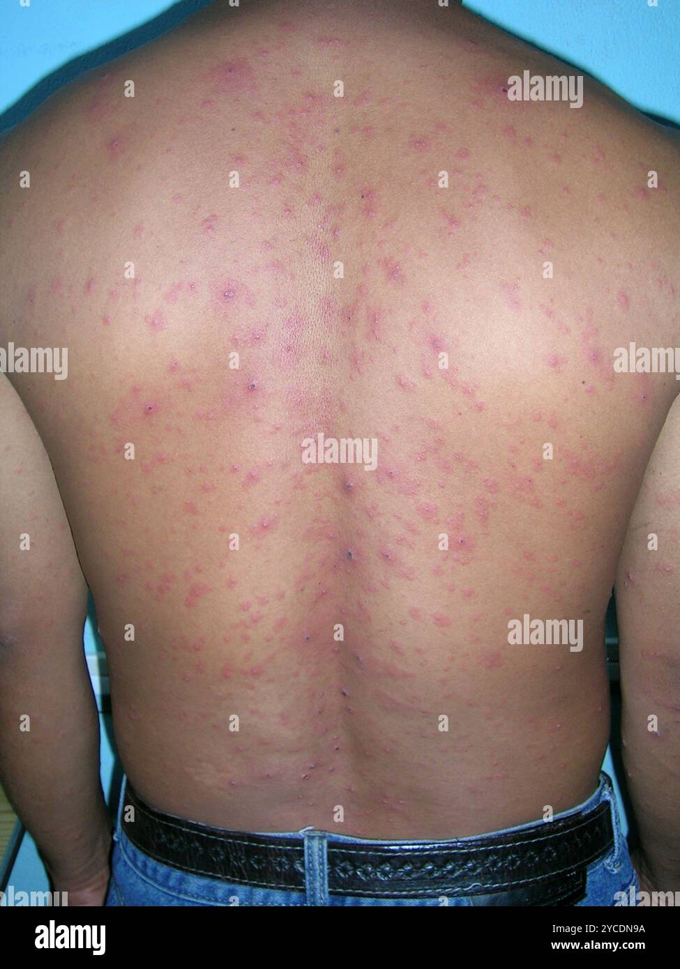Chickenpox rash on a 27 year old male patient's back. Chickenpox ...