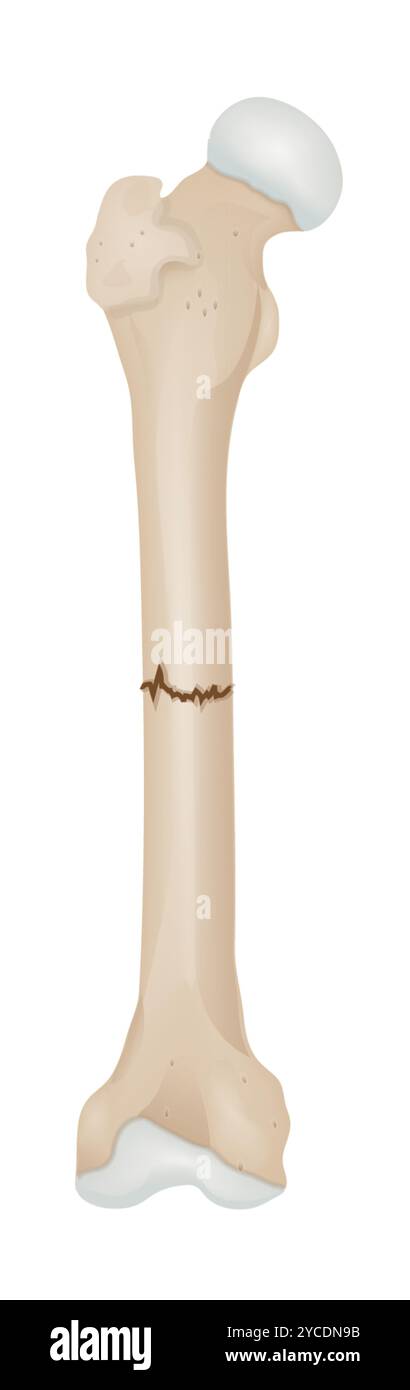 Illustration of a transverse femoral fracture. A transverse fracture is ...