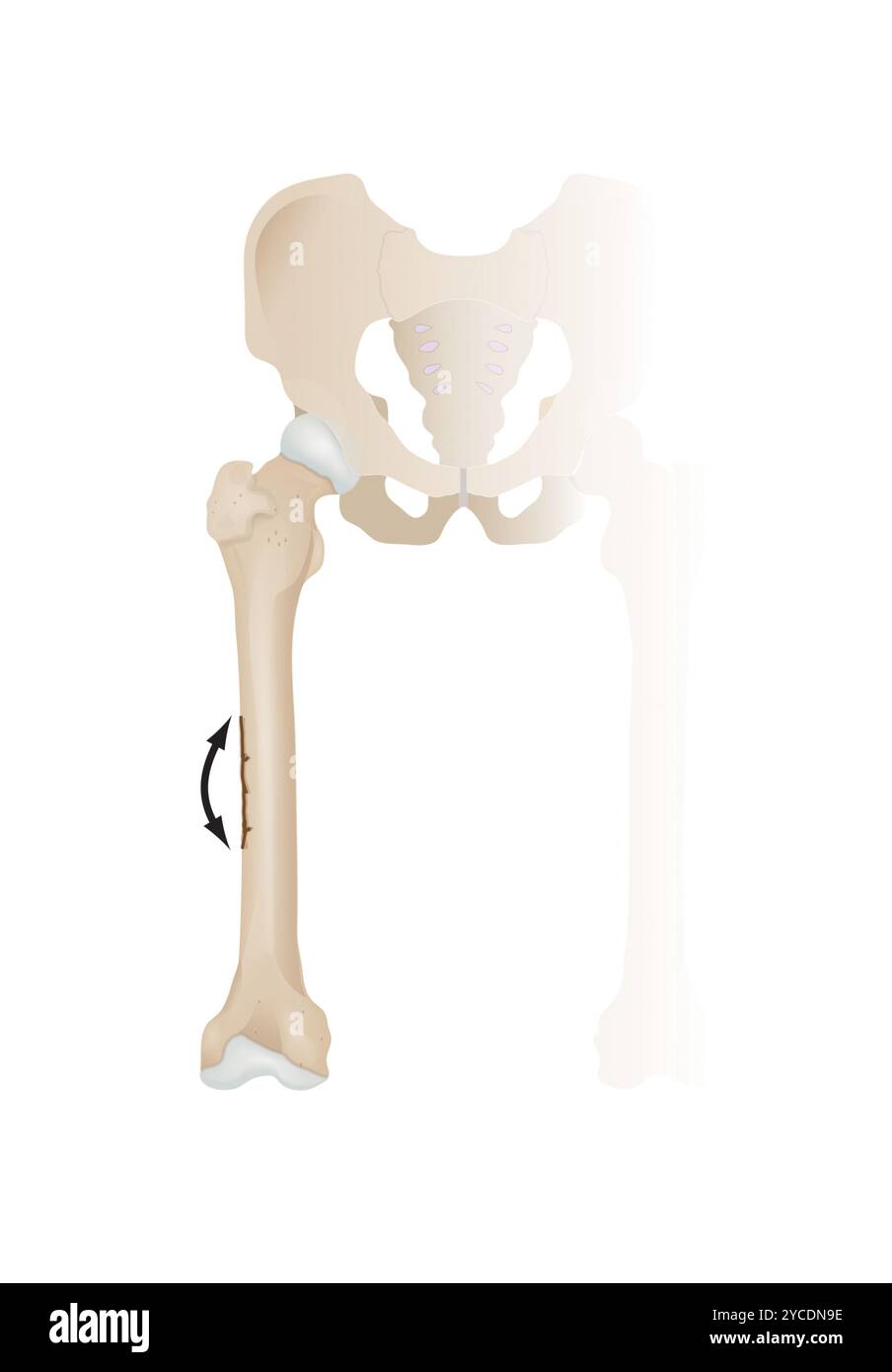 Illustration of a greenstick femoral fracture. Greenstick fractures ...