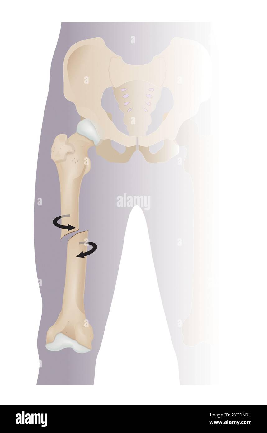 Illustration of a spiral femoral fracture. A twisting force to the ...